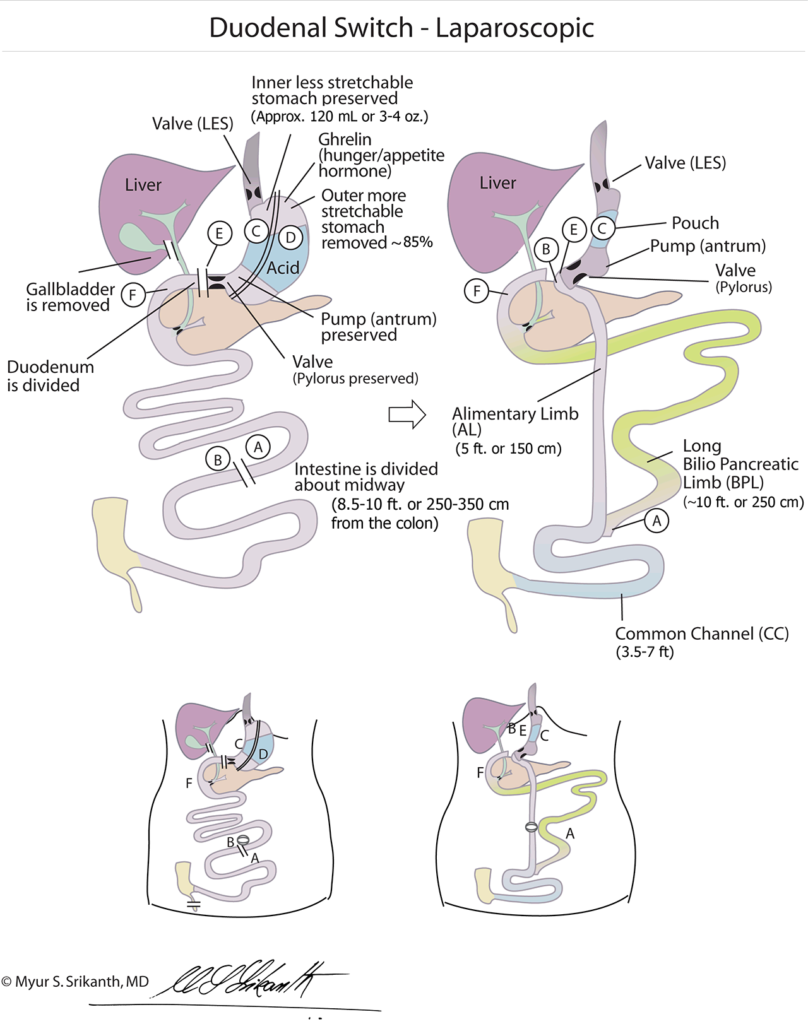 Laparoscopic Duodenal Switch Surgery in Washington State