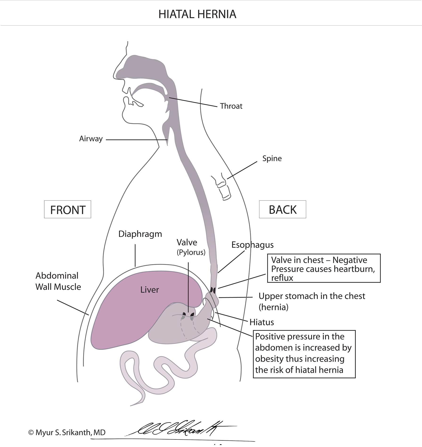 Hernia Hiatal Reflux Acid Hiatus Medical Stomach Diaphragm Wikipedia ...