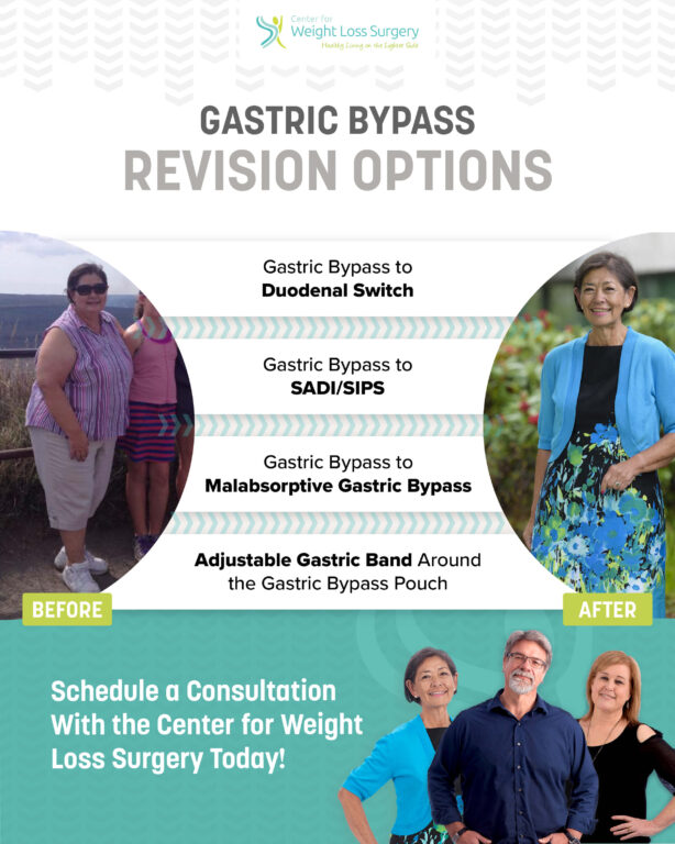 Gastric Bypass Revision Surgery | Seattle, WA | CWLS